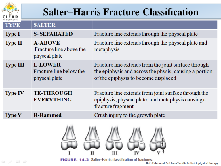 Salter–Harris Fracture Classification - clearptconcepts